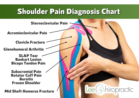 Understanding Shoulder Pain: A Comprehensive Diagnosis Chart - Irvine chiro